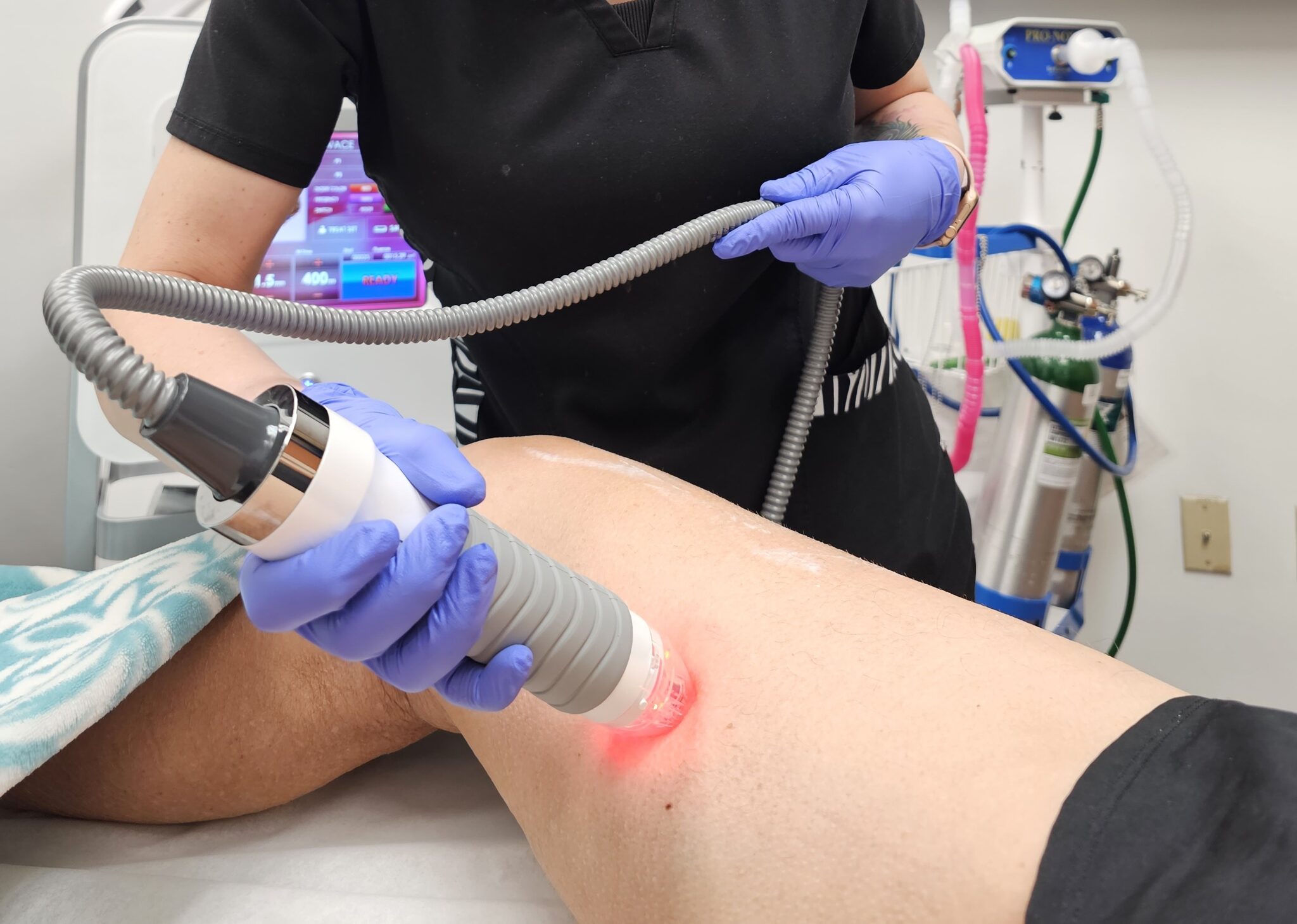 Vivace Micro-Needling with RF | Phoenix, AZ